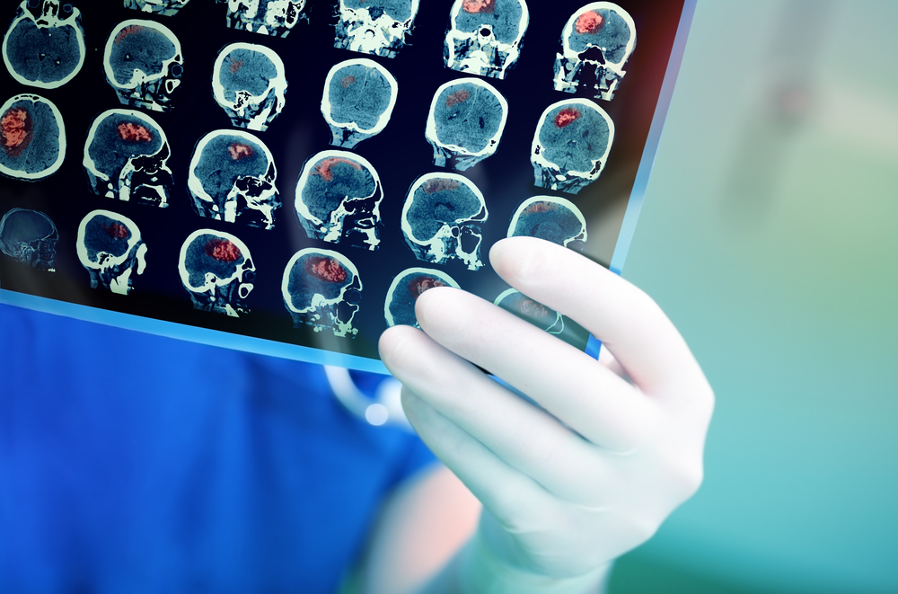 Treating Brain Cancer in NJ, CT, & MA – Regional Cancer Care Associates