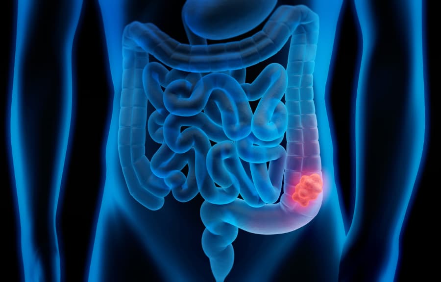 The Different Colon Cancer Stages in NJ, CT, & MA – Regional Cancer ...